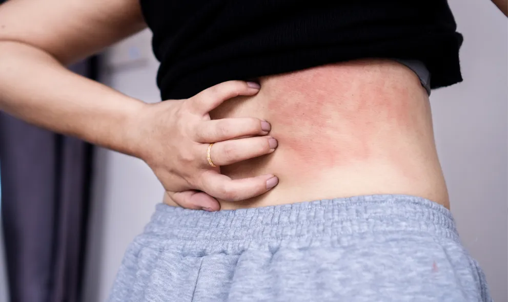 Stress and Skin: Can Anxiety Trigger Rashes? - RxLess app - RxLess app